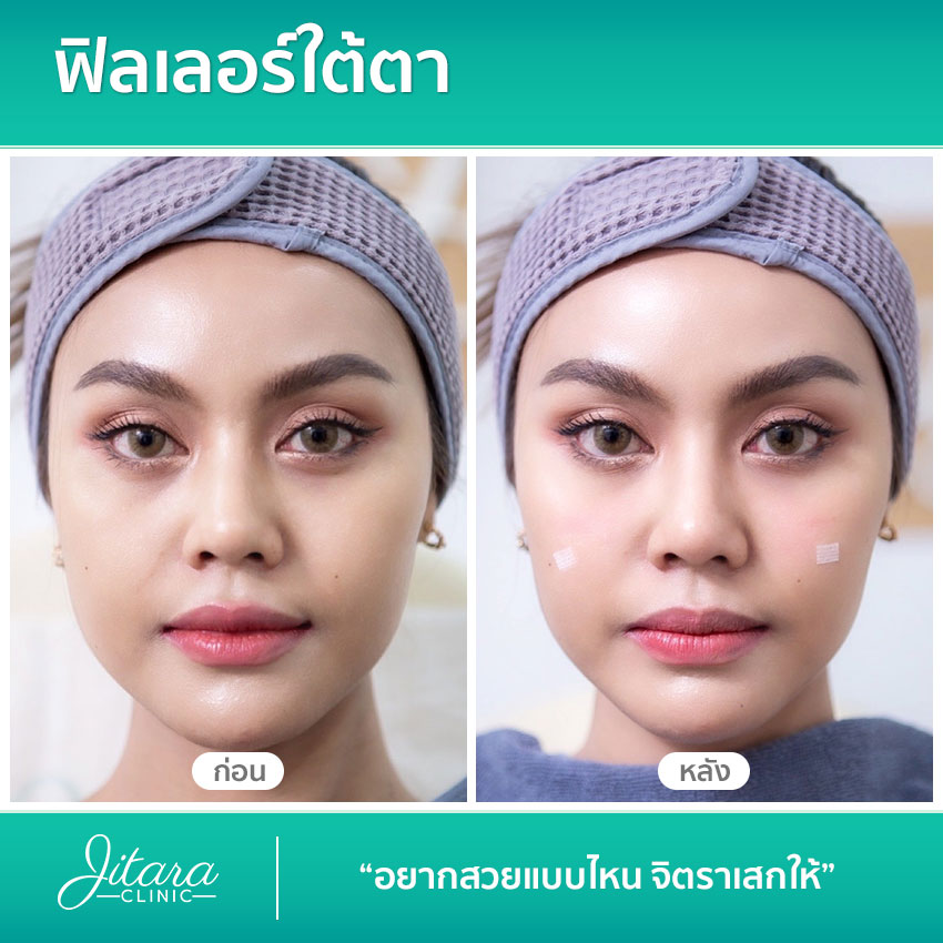 ฟิลเลอร์ใต้ตา - Jitara Clinic